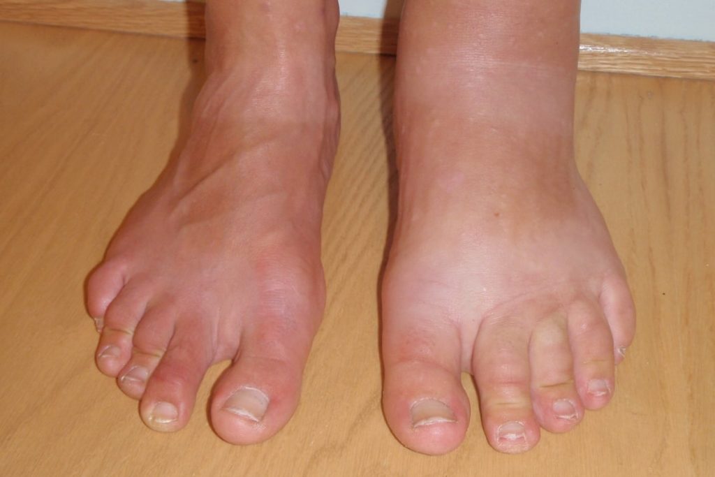 Edema